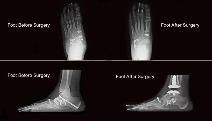 Complex Foot Deformity and Ankle Replacement - Dan Sullivan